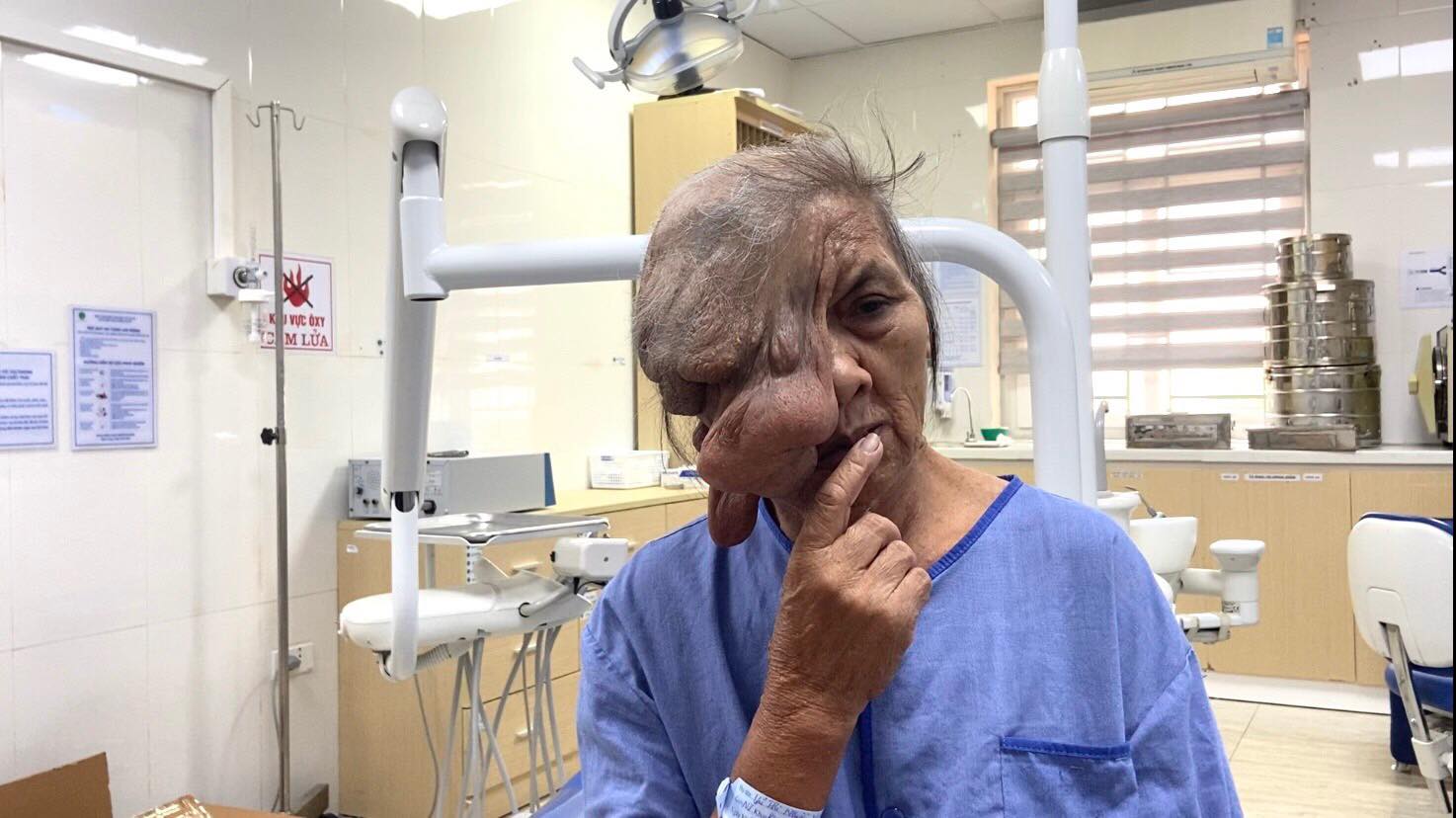 MS 786: Người phụ nữ đơn thân mang khối u khổng lồ trên mặt ước mong được phẫu thuật