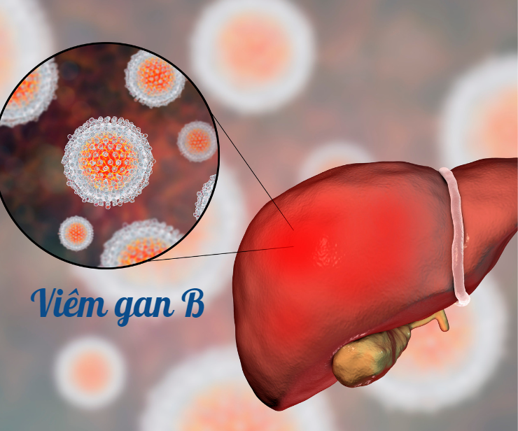 Hiểu đúng về viêm gan B để kiểm soát bệnh tốt